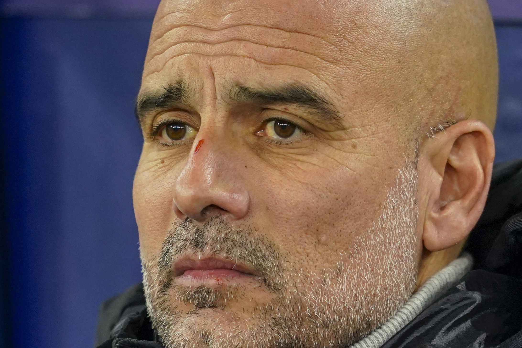 Pep Guardiola Says Scratches on Face Were Self-Inflicted